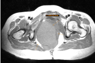 Perirectal Cyst-Differentials - Sumer's Radiology Blog