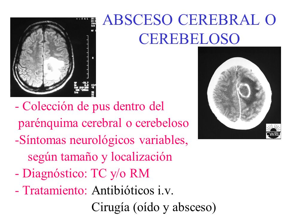 Neuropsicologia: ABSCESO CEREBRAL