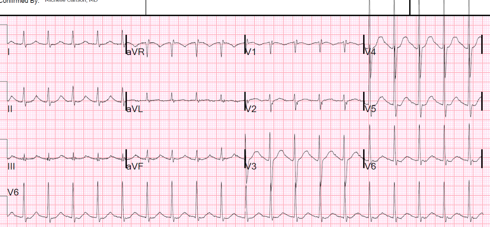 Dr. Smith's ECG Blog: August 2017
