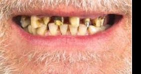 What is the Scurvy Disease?