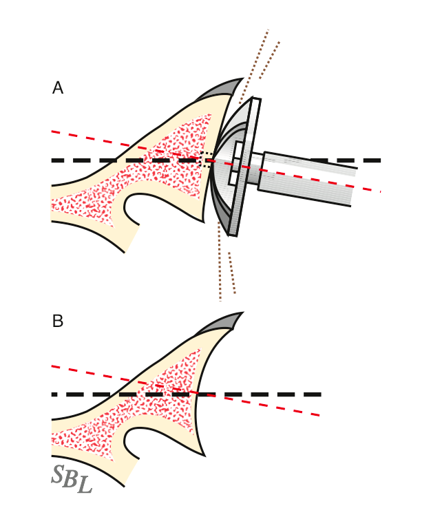 Shoulder Arthritis / Joint Replacement : Posterior augmented glenoid ...