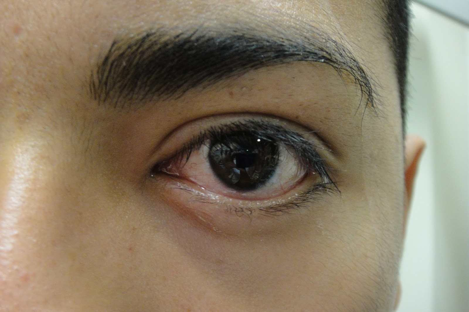 Uso de Mini Monoka en obstrucción del punto y del canalículo lagrimal