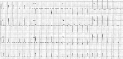ECG of the Week: ECG of the Week - 12th October 2015 - Interpretation