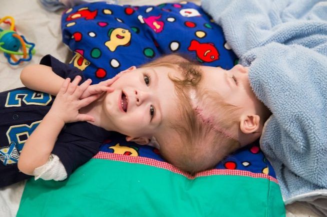 GÊMEOS SIAMESES UNIDOS PELO CRÂNIO SÃO SEPARADOS APÓS A MAIS LONGA ...