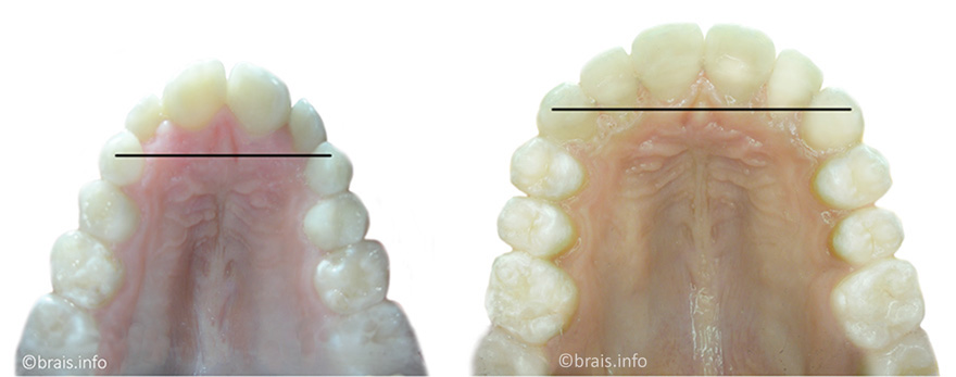 Logopedia LyG : ¿Por qué mi hijo pronuncia o habla mal? Deglución ...