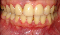 les cours dentaire: LA PARODONTITE AGRESSIVE GENERALISEE CHEZ LE ...