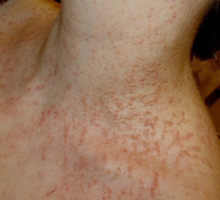 Dermatology: DARIER DISEASE