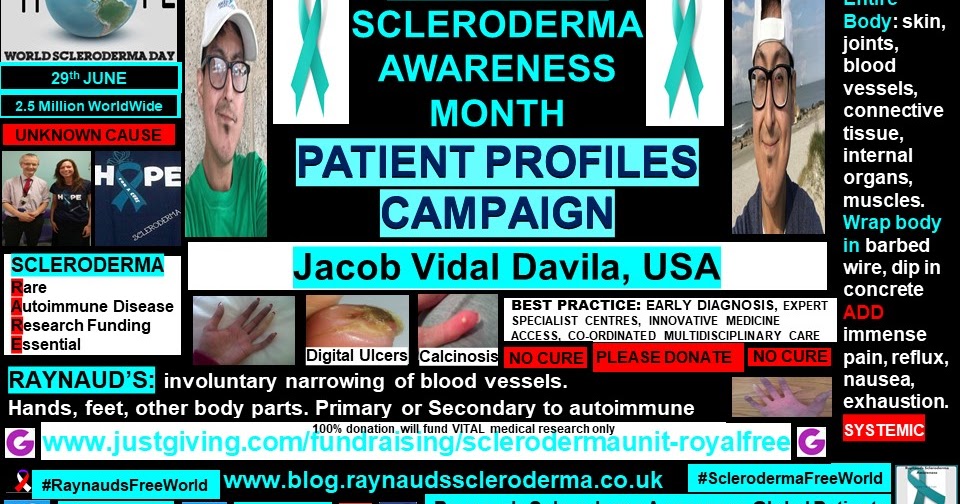 Raynauds Scleroderma Global Patients: Jacob Vidal Davila, USA. June ...
