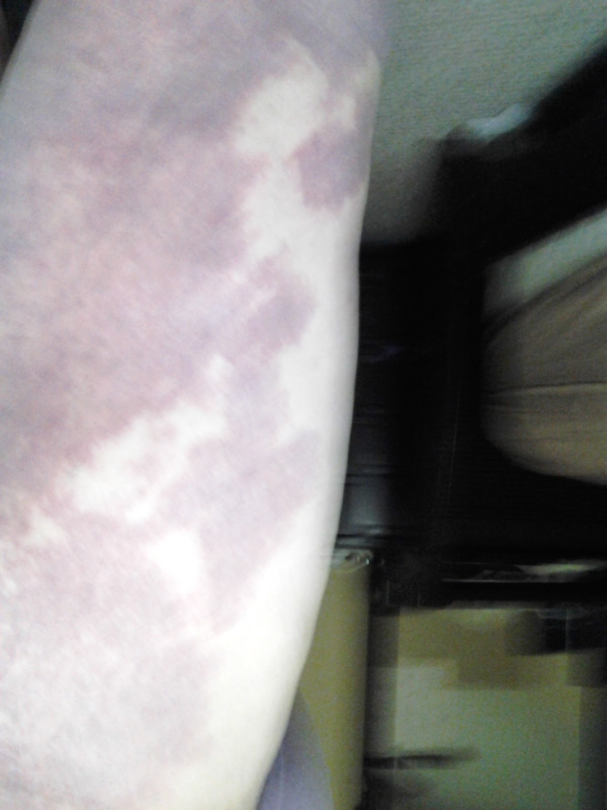 Kisses for KTS (Klippel-Trenaunay Syndrome): See Other Patients' Pictures!