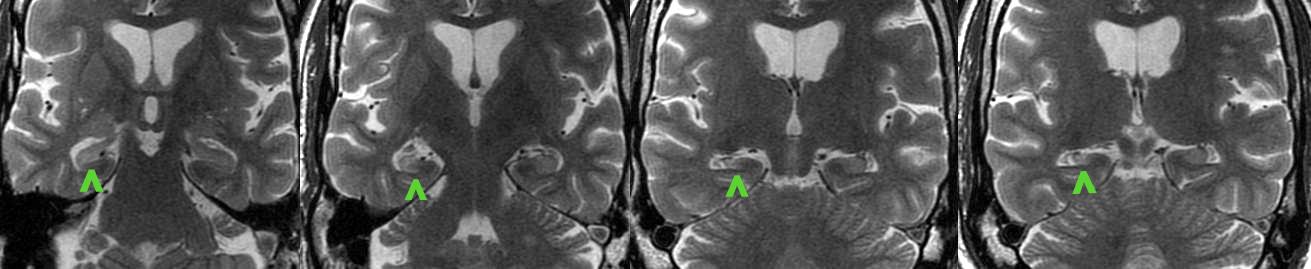 Dr Balaji Anvekar FRCR: Mesial temporal Sclerosis MRI