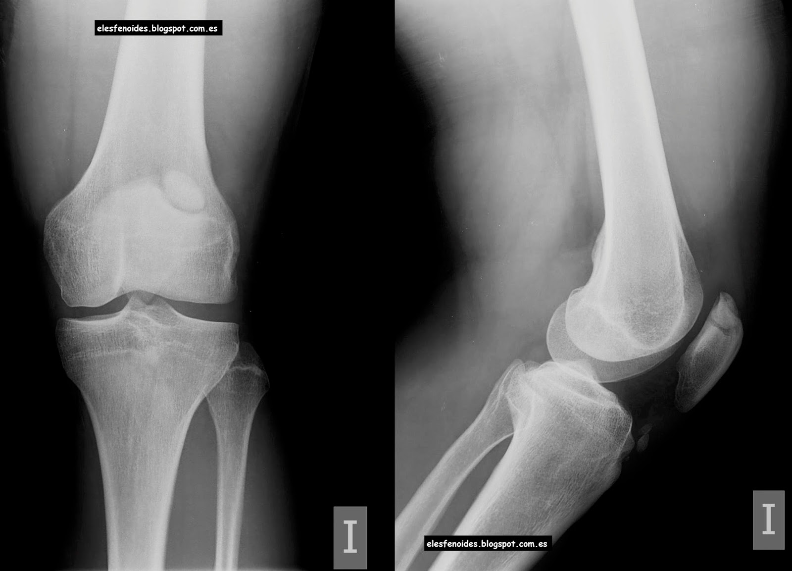 El esfenoides: Enfermedad de Osgood-Schlatter. 2 imágenes 1 caso.
