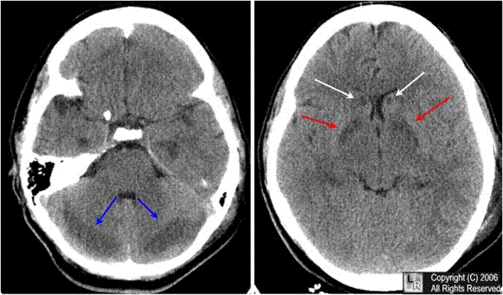 Image Bank: Basal ganglia and dentate nucleus damage in Carbon Monoxide ...