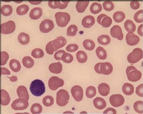 FICHERO DE HEMATOLOGIA: MICROCITOSIS