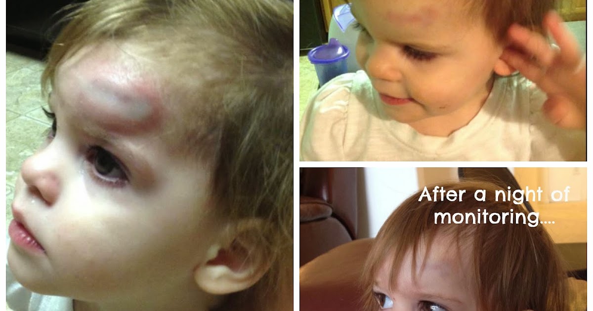 Heavenly Drops of Love: How to Treat a "Goose Egg" on your toddler...