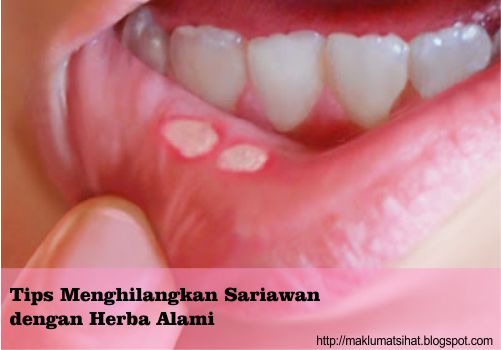 Tips Menghilangkan Sariawan dengan Herba Alami - Maklumat Kesihatan