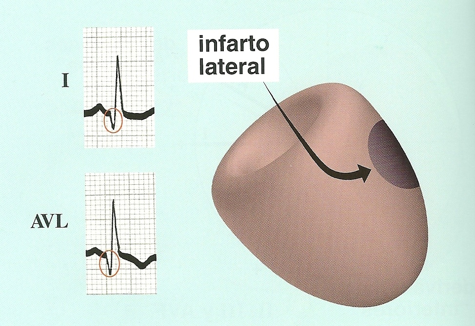 Electrocardiograma y Medicina General: Infarto agudo de miocardio de ...