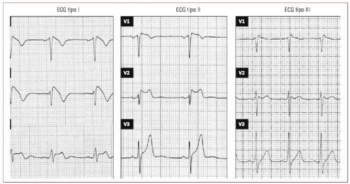 Trencadors docent: El síndrome de Brugada