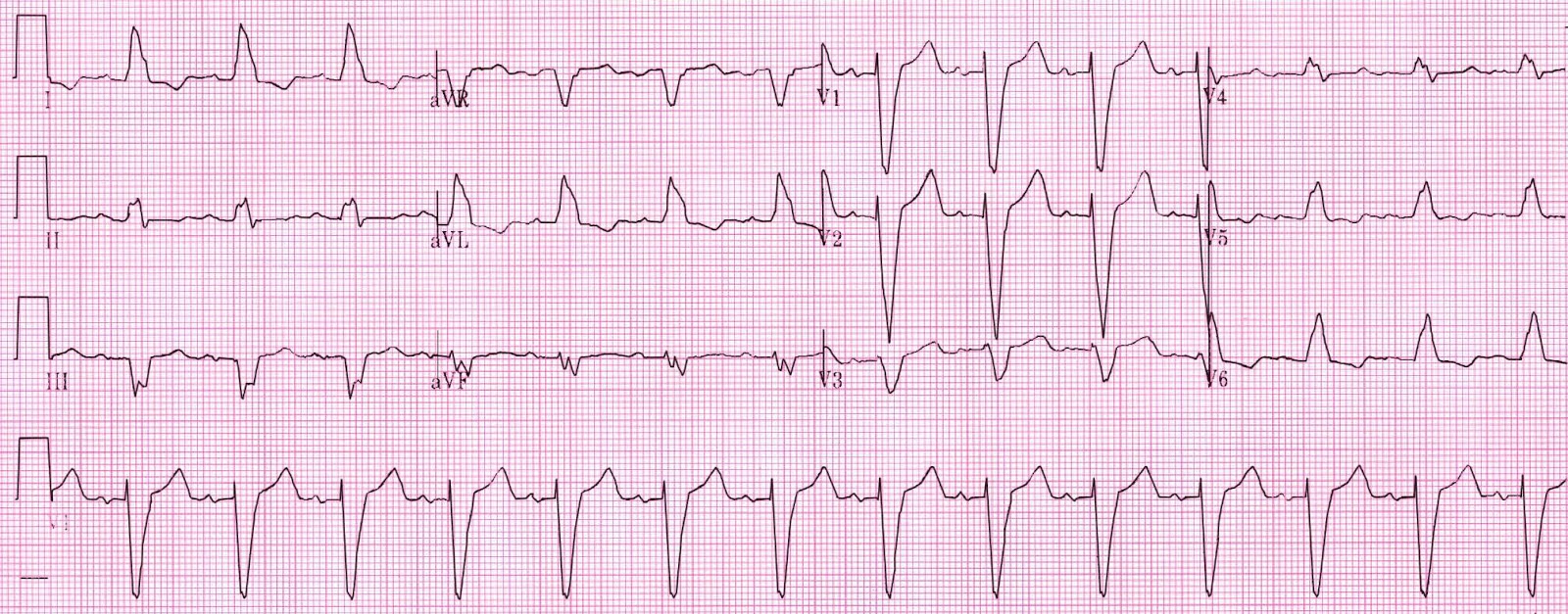 Left Bundle Branch Block Ekg Examples Left Bundle Branch Block Ekg Examples