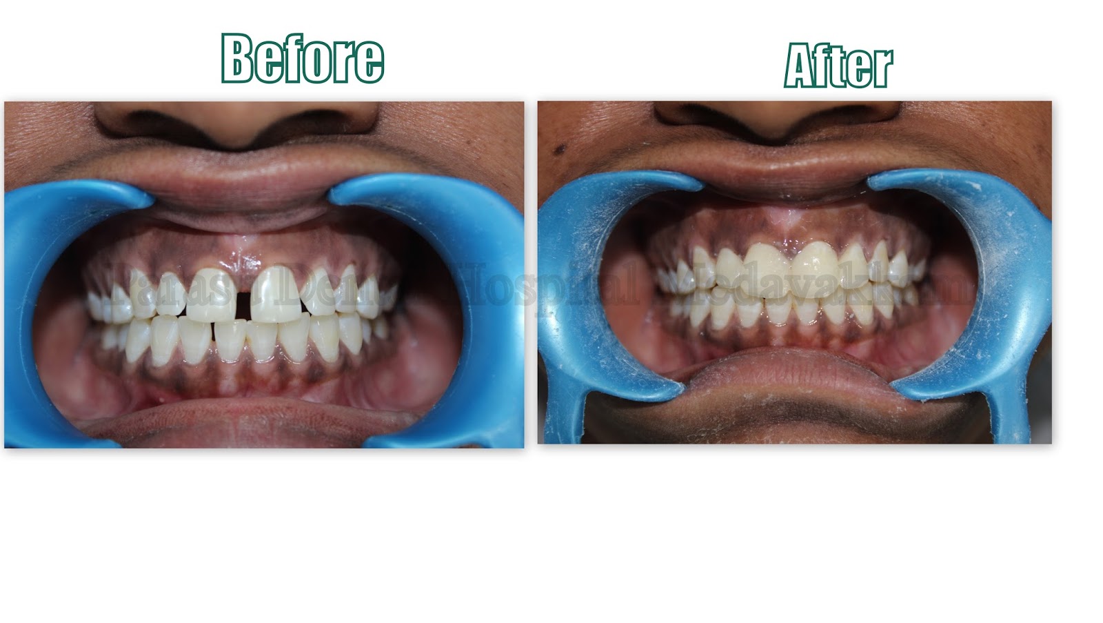 all on 4 implants in chennai: midline diastema closure with composite ...