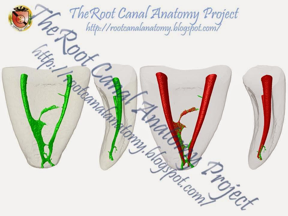 Root Canal Preparation: Mandibular Molar