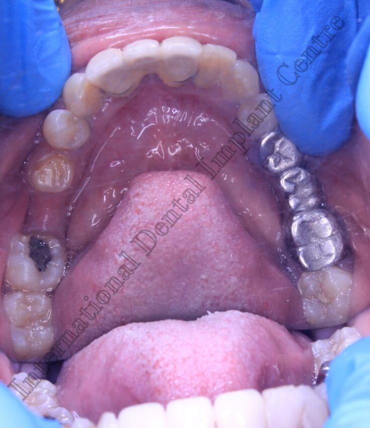 DR Murugavel's dental implant course: Upper and lower missing molar ...