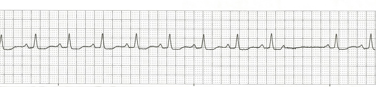 EKG Rhythm Strip Quiz 74