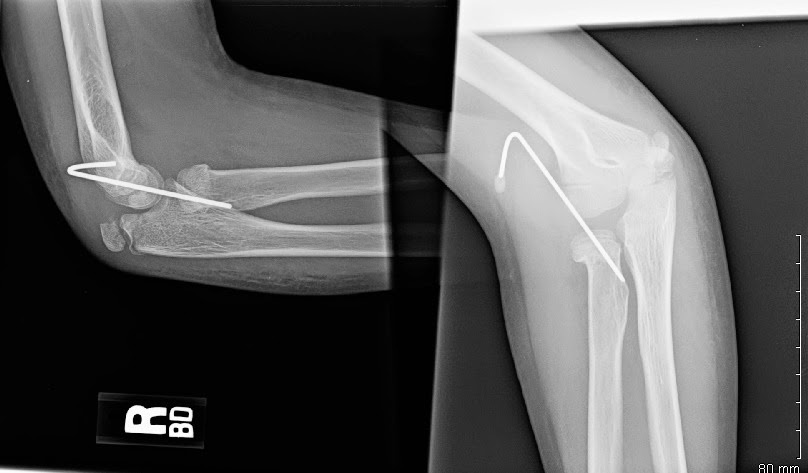 Shoulder and Elbow Surgery: Pediatric radial neck fractures