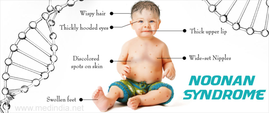 The Noonan Syndrome Characteristics You Must Know