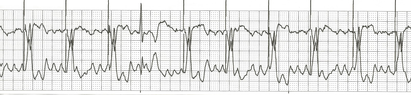 Float Nurse: EKG Rhythm Strips 83