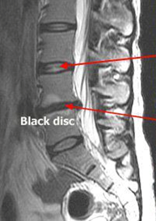LIGAMENTO INTERESPINOSO LUMBAR