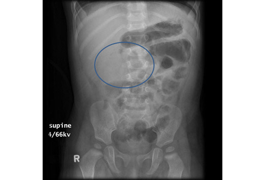 Sudiyatmo,MD Blog & Journal: Invaginasi (Intussusception) pada Dewasa