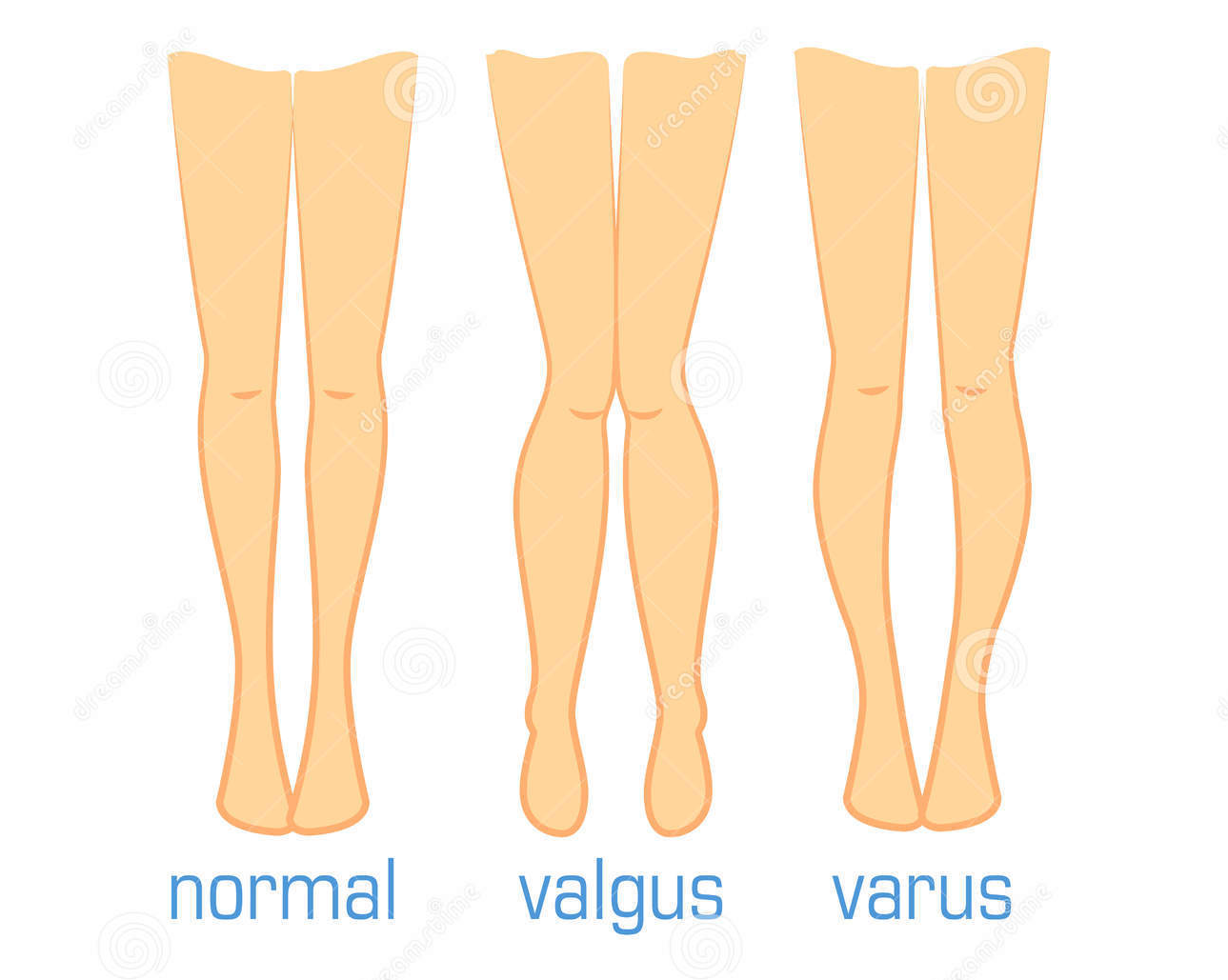 O Guia do Fisioterapeuta: Valgo dinâmico de Joelho