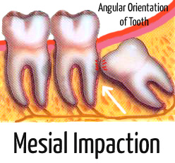 Four Wisdom Tooth Impactions and What They Mean