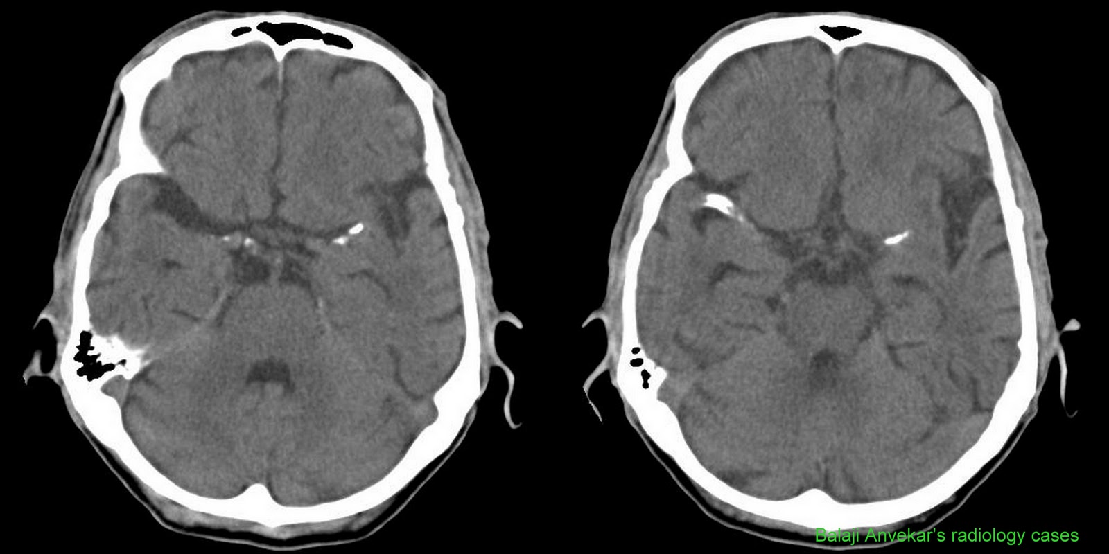 Brain Calcification