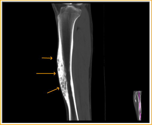 Adamantinoma Tibia -Cross sectional Imaging - Sumer's Radiology Blog