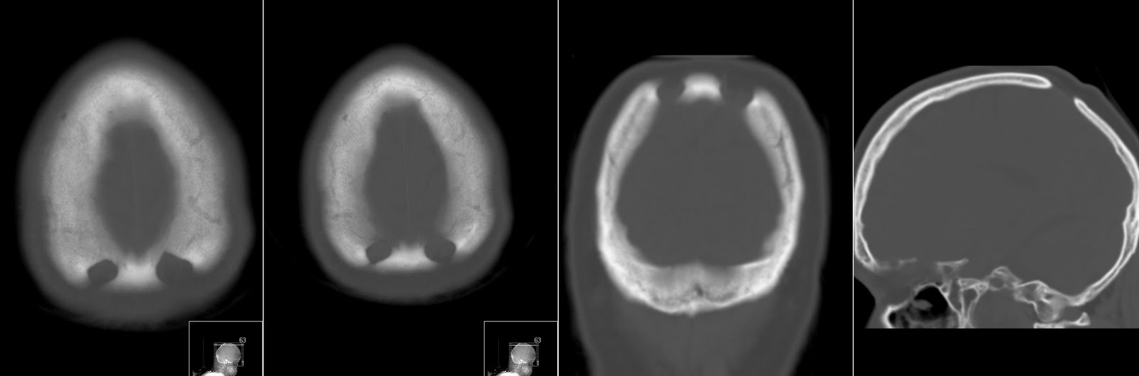Enlarged Parietal Foramina