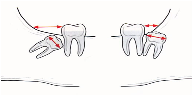 Dentistry and Medicine: Surgical management of Unerupted and Impacted teeth