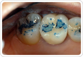 High points after dental restoration | Rahul Shinde Blog