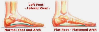 Home: Kaki Datar (Flat Foot / Pes Planus)