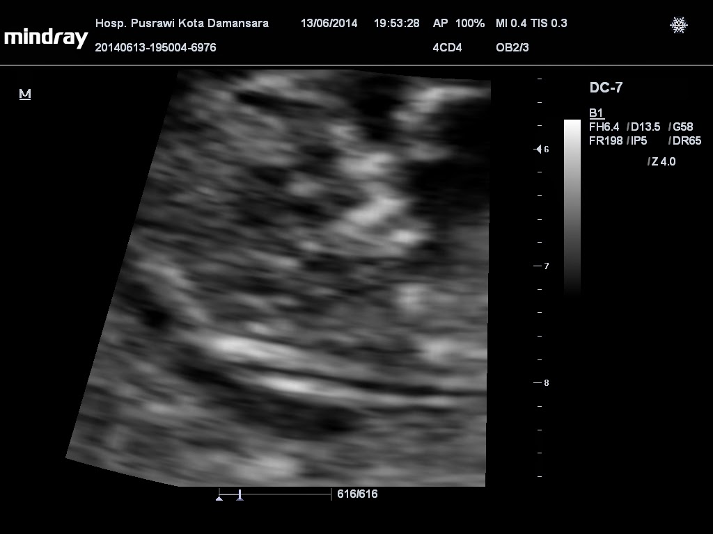 My Ultrasound life : NT scan (Nuchal traslucency) at week 12