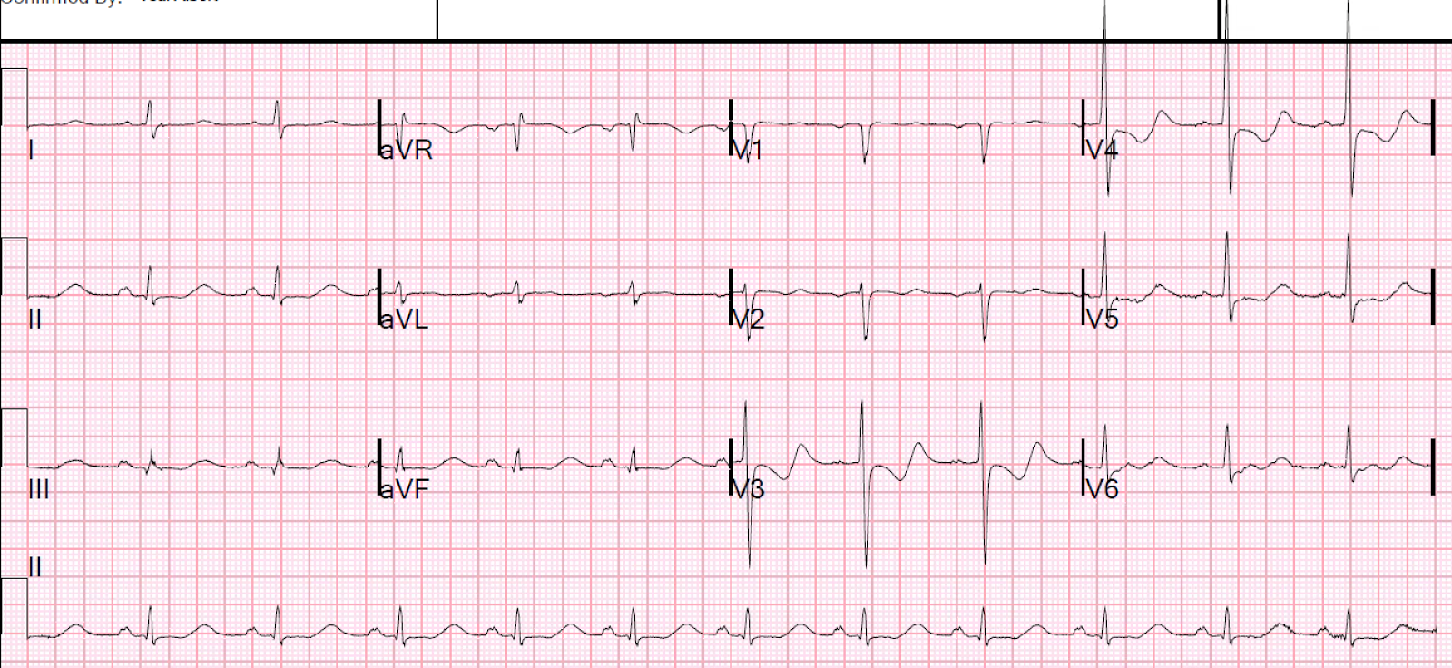 Dr. Smith's ECG Blog: Are These Wellens' Waves??