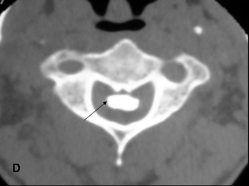MRI MEDIC CASE STUDIES COLLECTION: Ossification of the posterior ...