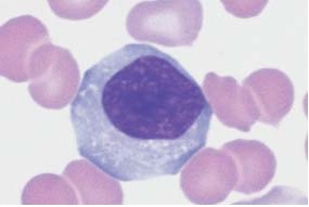 [Haematology] Abnormalities of the White Cell Series | Free Medical Atlas