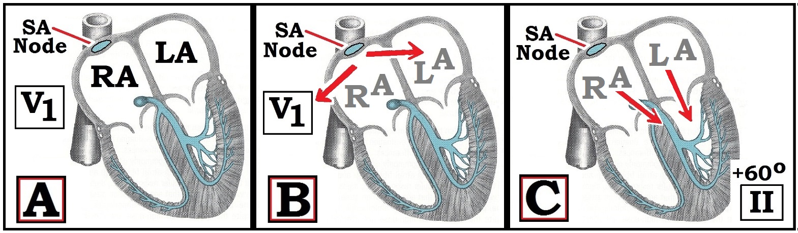 ECG Interpretation: ECG Blog #75 — LAA vs LAE vs Not ...
