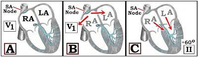 ECG Interpretation: ECG Blog #75 — LAA vs LAE vs Not ...