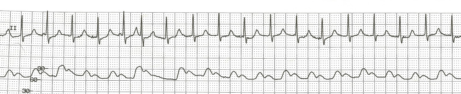 EKG Rhythm Strips of Unstable SVT with Arterial Blood Pressure Waveform
