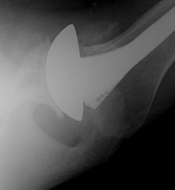 Shoulder Arthritis / Rotator Cuff Tears: causes of shoulder pain: The ...