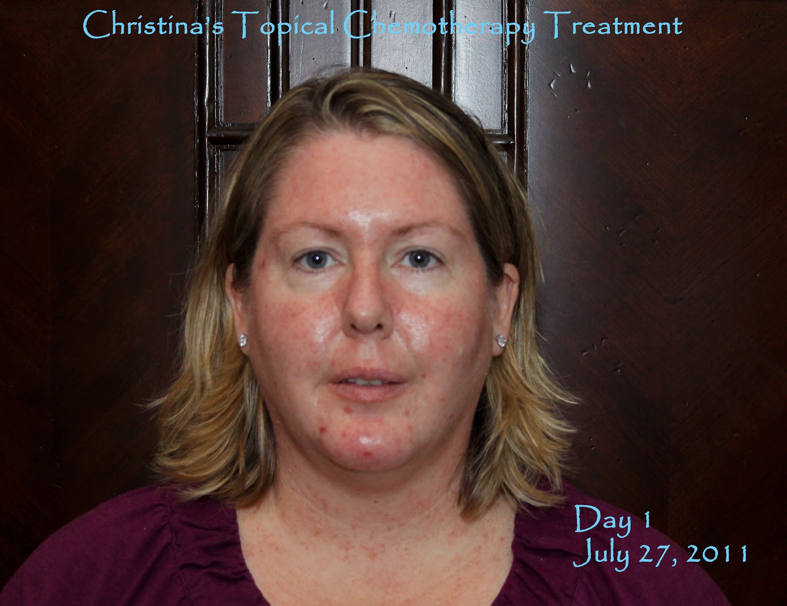 My Journey Through Topical Chemotherapy - Fluorouracil 5% Cream and ...