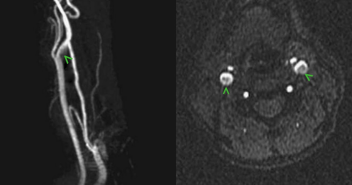 Dr Balaji Anvekar FRCR: Neck MR Angiography Pitfall