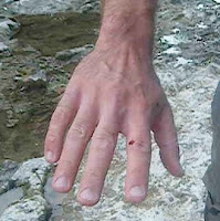 Springfield Plateau: Anatomy of a Snake Bite